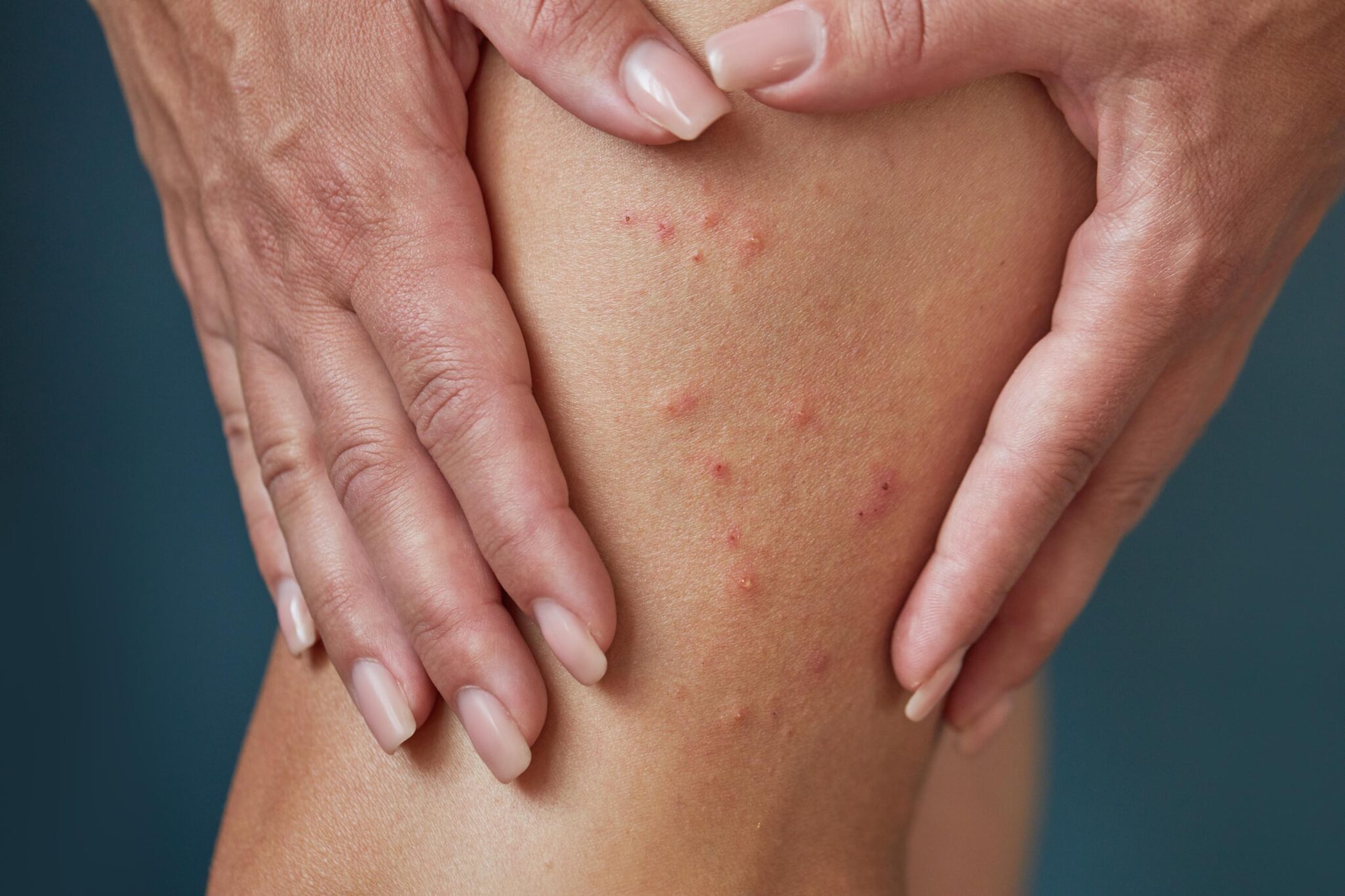 Sarna Openderma Sarna Openderma